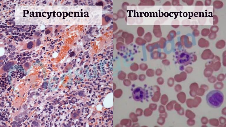 Pancytopenia Treatment In India | Symptoms & Causes | Medsurge India