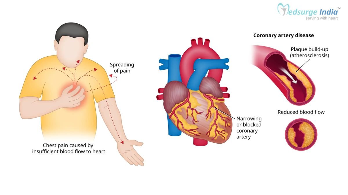 Unstable Angina | Things To Know About Unstable Angina | Medsurge India