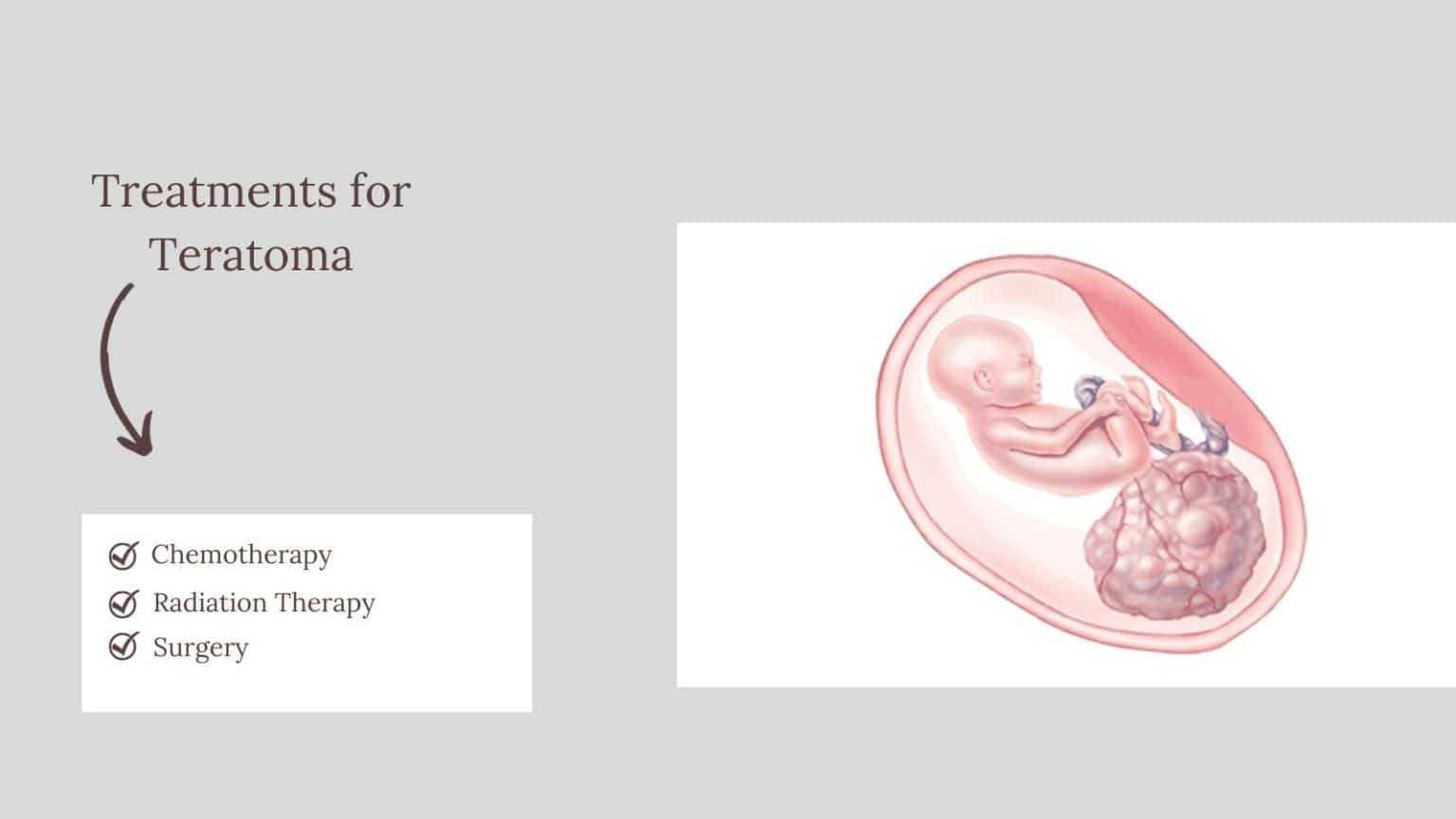 Teratoma Treatment Cost In India | Medsurge India